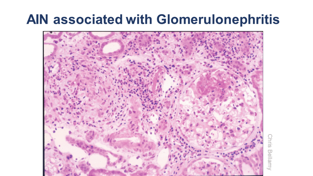Acute interstitial nephritis txt – Renal